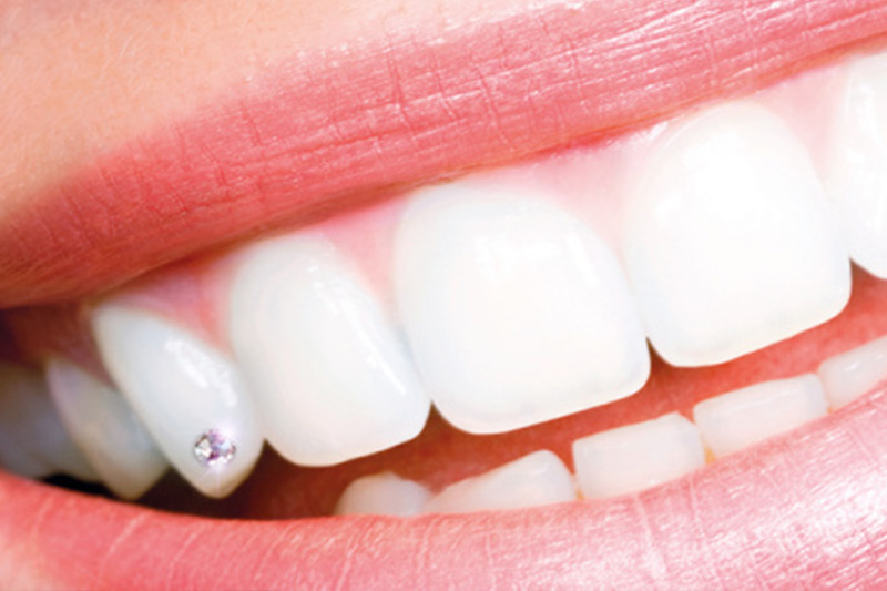 Smile With A Sparkle | Lumino The Dentists